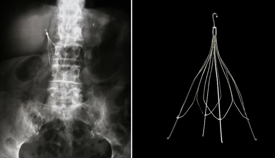 ivc filter description